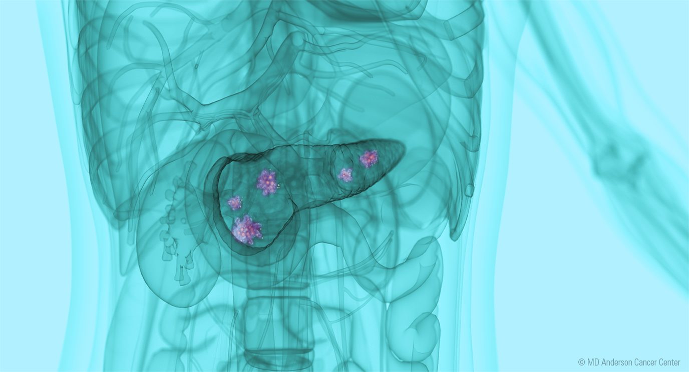 Pancreas Cancer
