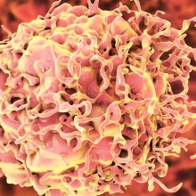 What is Colon Cancer? Symptoms, Risk Factors & Treatments | MD Anderson ...