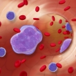 Lymphoma: Symptoms, Types & Risk Factors | MD Anderson Cancer Center