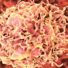 Colorectal Cancer - Definition, Symptoms & Risk Factors | MD Anderson ...