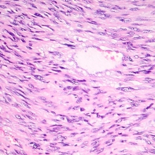 Soft Tissue Sarcoma Symptoms, Facts, Diagnosis, and Treatment | MD ...