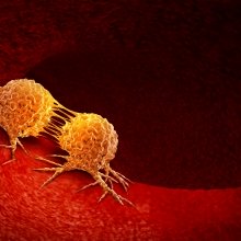 What are Brain Metastases? Symptoms, Risk Factors & Treatments | MD ...