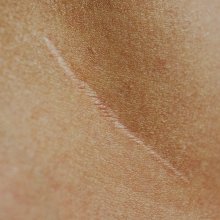 Cancer Treatment Surgery | MD Anderson Cancer Center