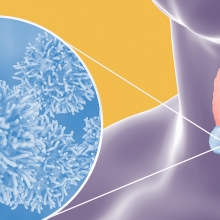 Thyroid Cancer - Types, Symptoms, Treatment, Staging & Diagnosis | MD ...