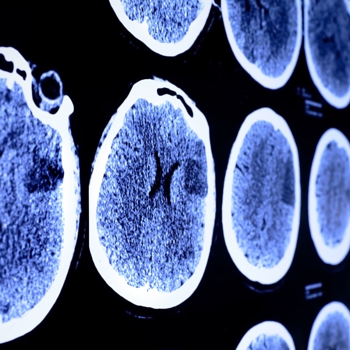 Brain Tumor Treatment | MD Anderson Cancer Center