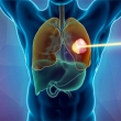 6 Innovative Lung Cancer Treatment Options | MD Anderson Cancer Center
