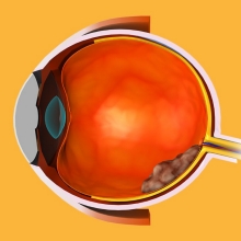 Retinoblastoma - Definition, Symptoms, Diagnosis & Treatment ...