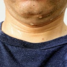 Lymphoma: Symptoms, Types & Risk Factors | MD Anderson Cancer Center