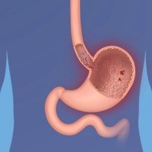 Bleeding and Bruising in Cancer Patients | MD Anderson Cancer Center