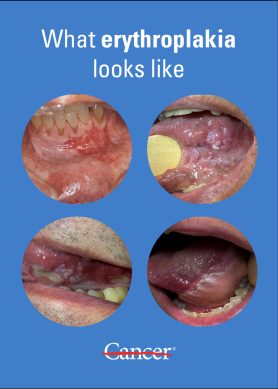 Erythroplakia Inside Cheek