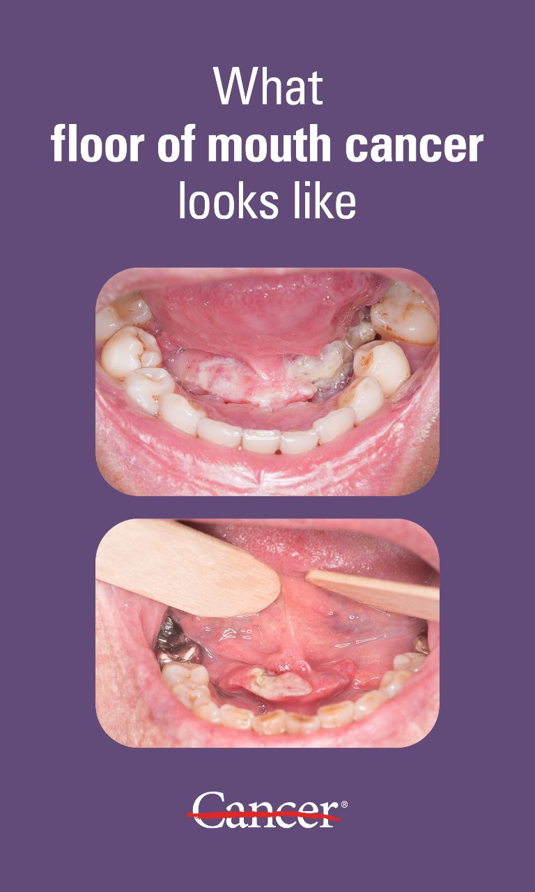 mouth cancer symptoms