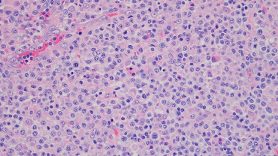 Lymphoma Cells Under Microscope