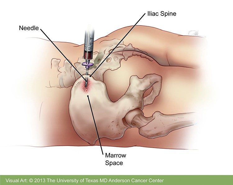bone marrow test