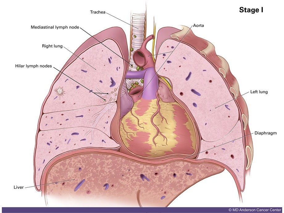 Lung Cancer Staging | MD Anderson Cancer Center
