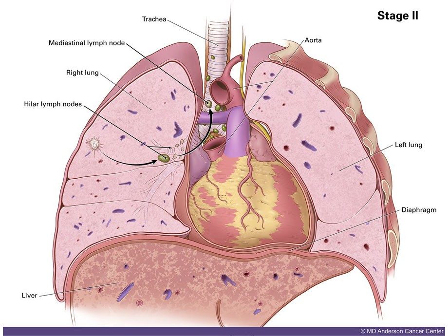 Lung Cancer Staging | MD Anderson Cancer Center