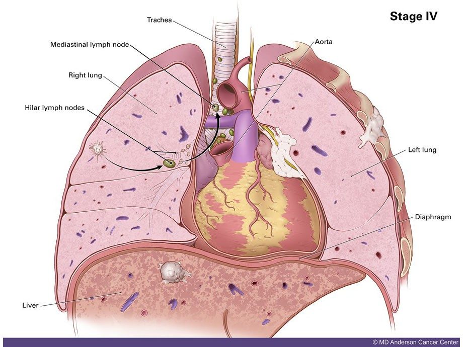 Lung Cancer Staging | MD Anderson Cancer Center