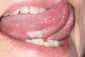 oral cancer tongue lesions