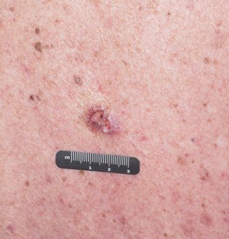 Basal Cell Carcinoma | UT MD Anderson