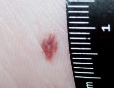 Basal Cell Carcinoma | UT MD Anderson