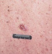 Skin Cancer | UT MD Anderson