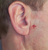 Skin Cancer | UT MD Anderson