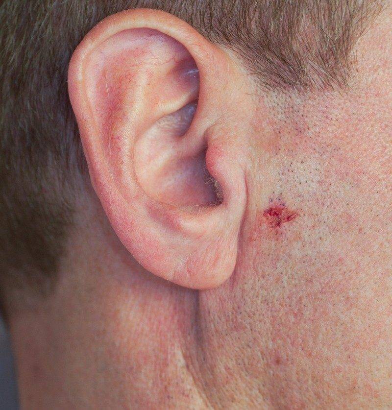 types of skin cancer lumps