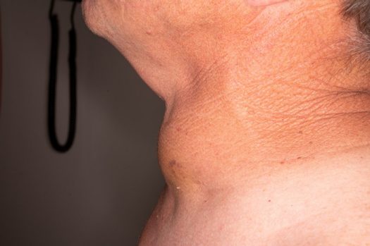 8 Top Thyroid Cancer Symptoms & Signs | MD Anderson Cancer Center