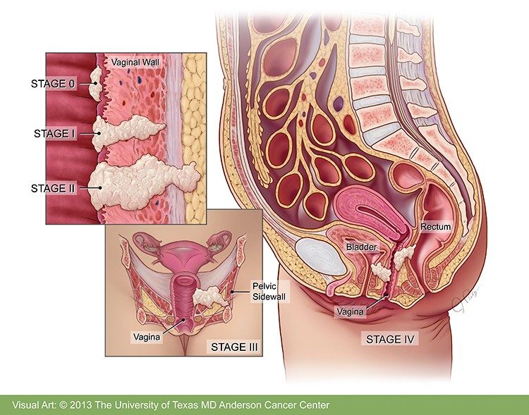 Carcinoma Vaginal Vaginal Cancer: Stages, Diagnosis & Treatment
