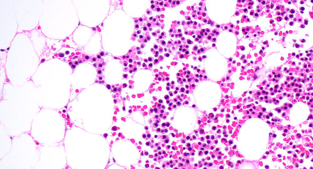 Combination therapy well-tolerated and highly effective for patients ...