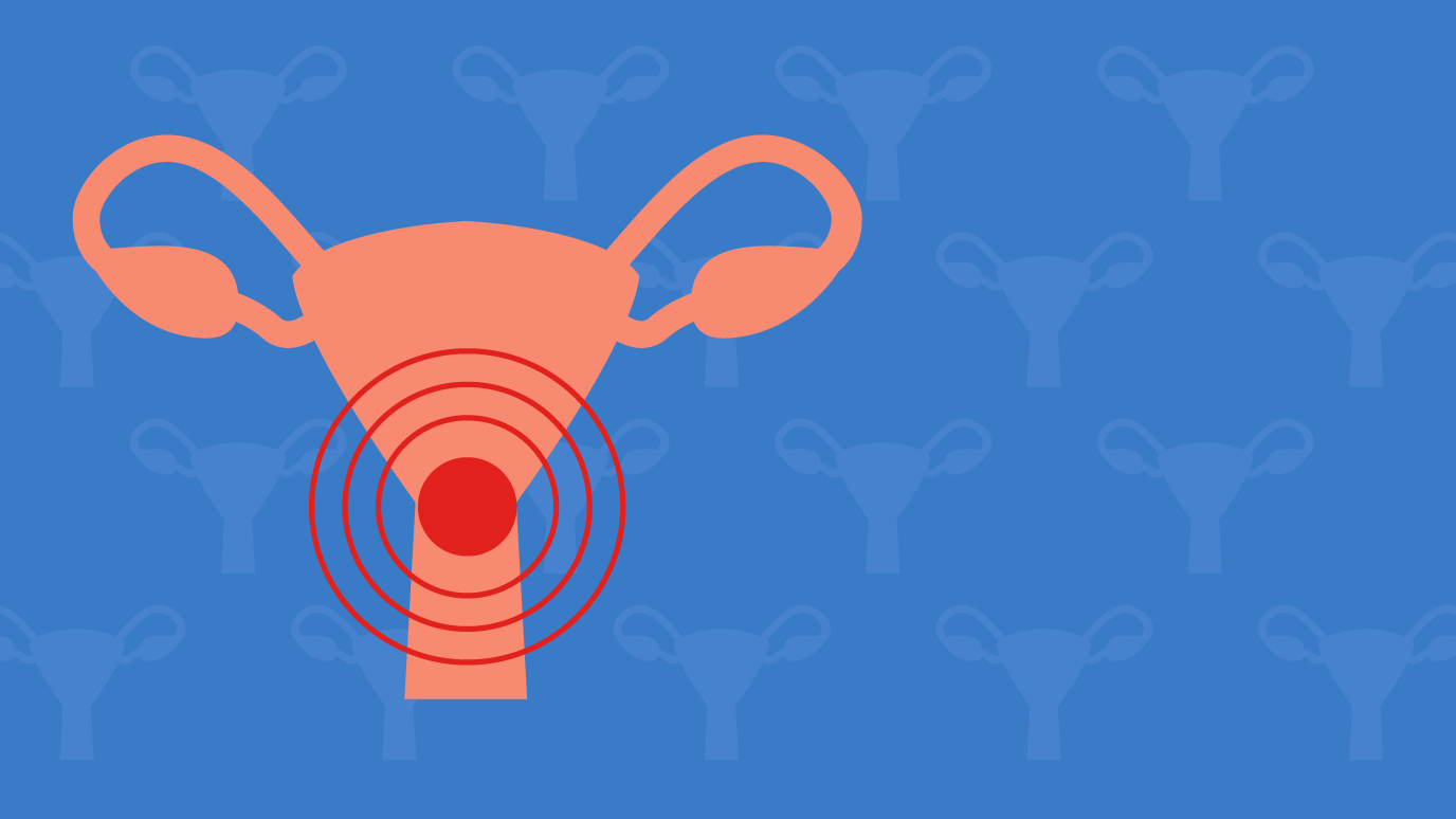 Cervical cancer rates rising in low-income U.S. counties | MD Anderson ...