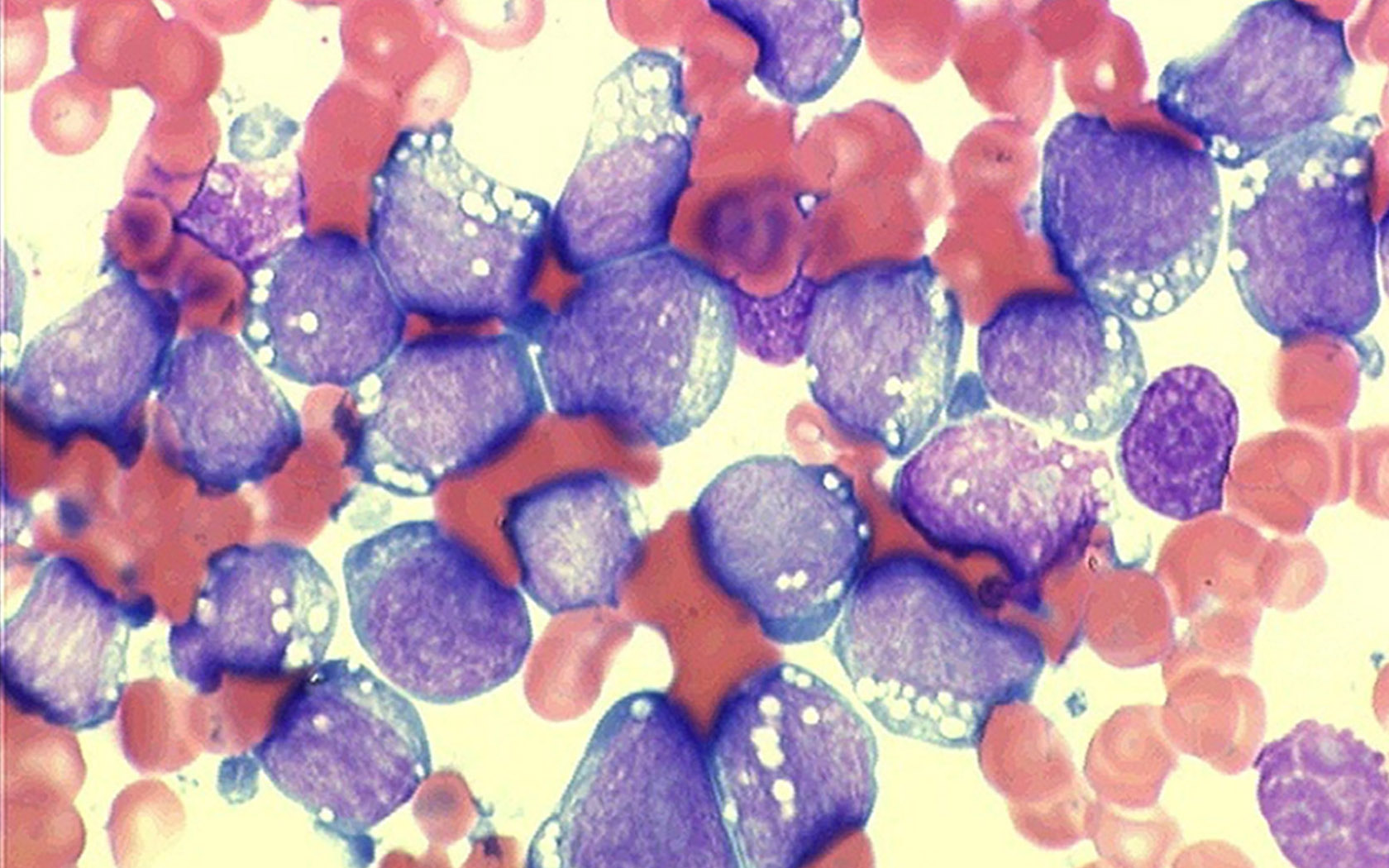 Combination therapy shows promise for chronic myeloid leukemia | MD ...