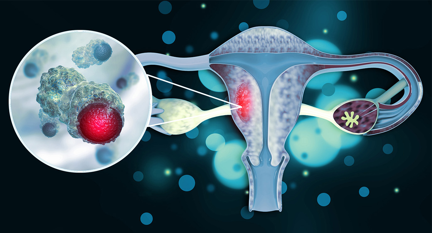 ESMO: PARP inhibitor plus immunotherapy lowers risk of endometrial ...