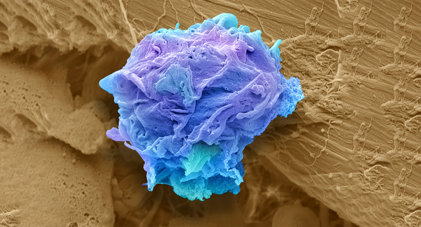 ASH: Mantle cell lymphoma patients see improved outcomes with oral ...