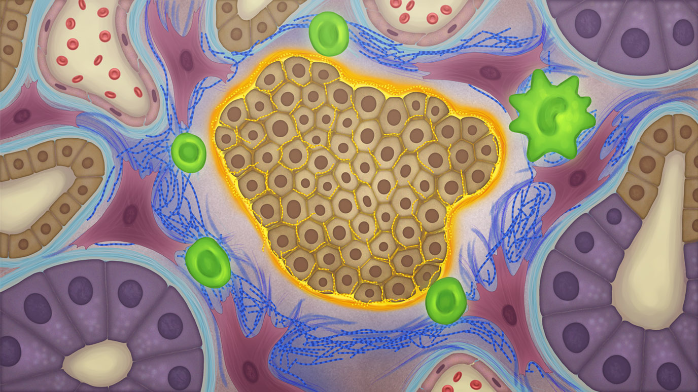 Cancer cells make unique form of collagen, protecting them from immune ...