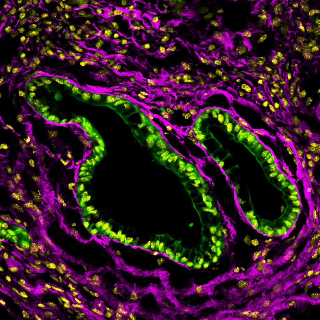 Collagen plays protective role during pancreatic cancer development ...