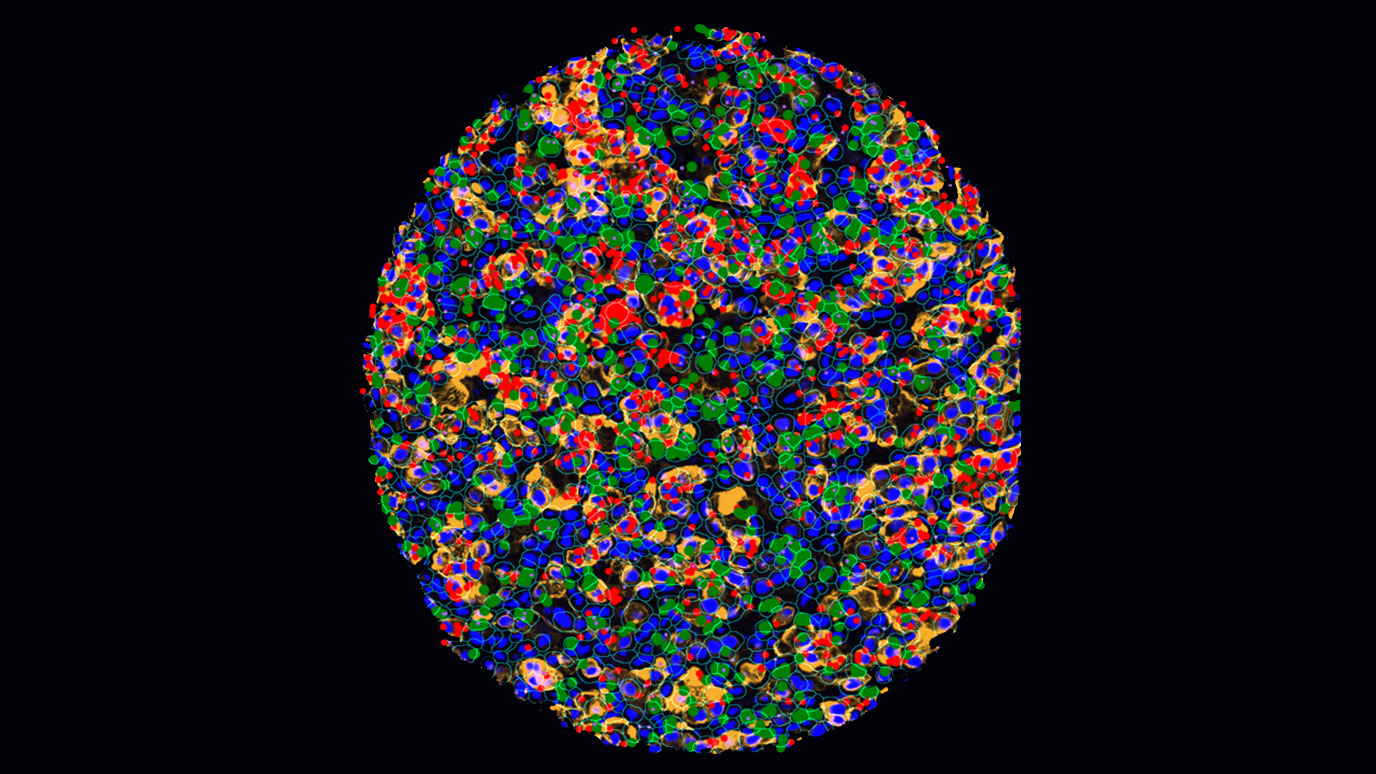 AACR: Single-cell study uncovers distinct immunosuppressive tumor ...