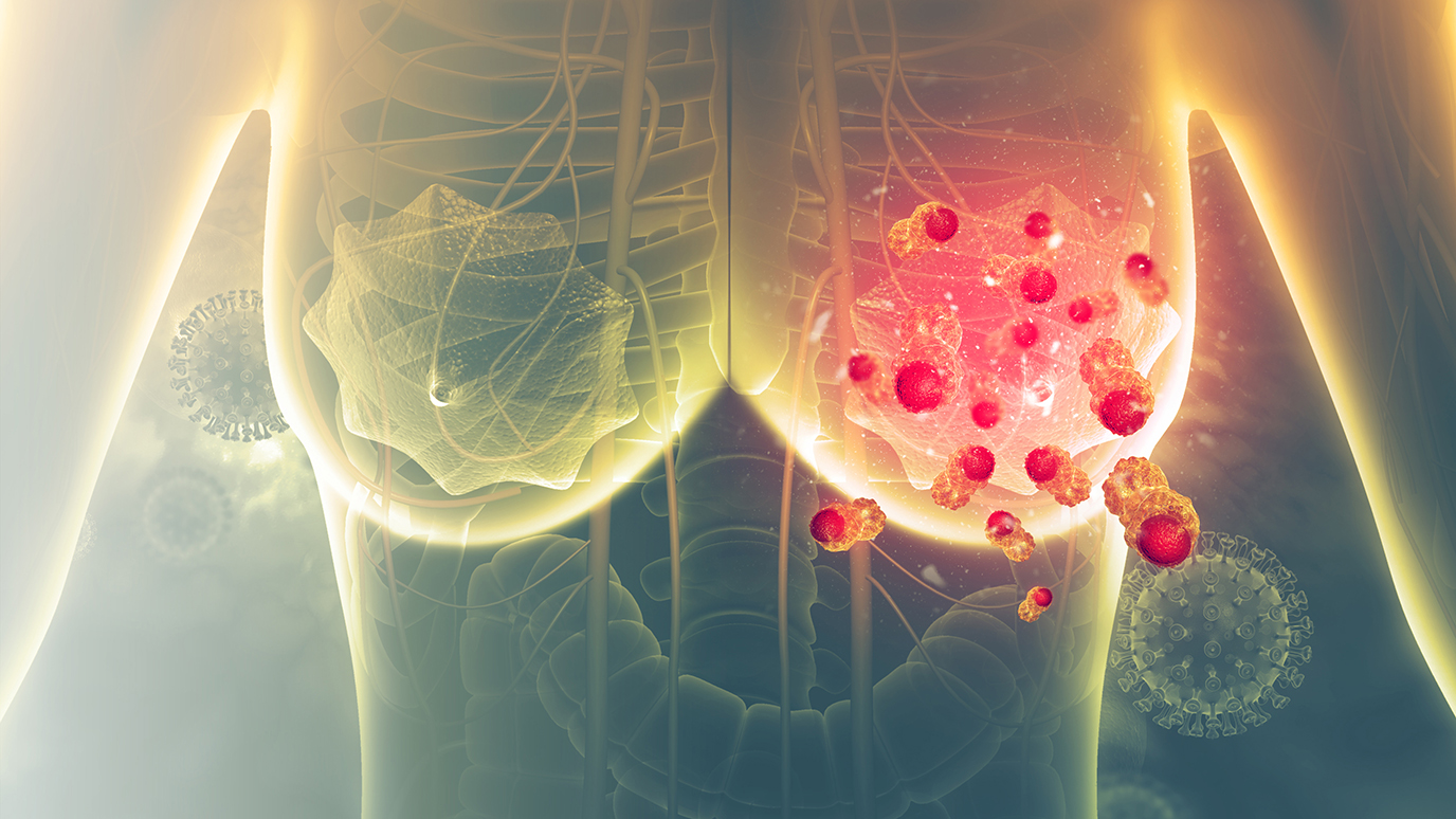 Tucatinib extends survival for metastatic HER2+ breast cancer patients ...