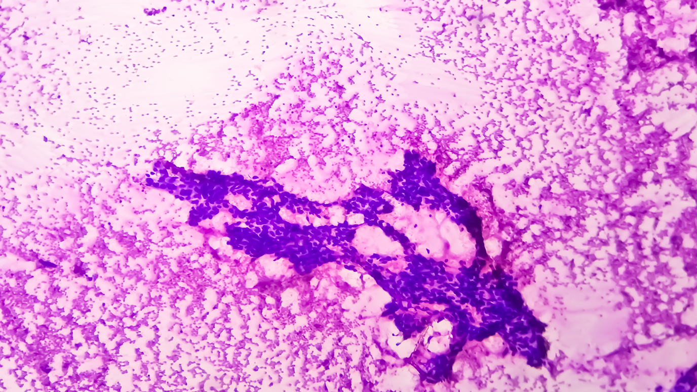 AACR: PARP1-selective inhibitor demonstrates early efficacy in breast ...