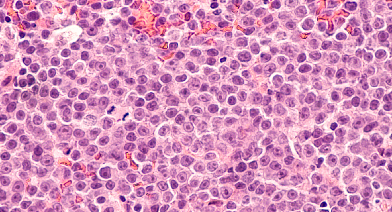 ASCO: Axi-cel significantly improves survival in patients with early ...