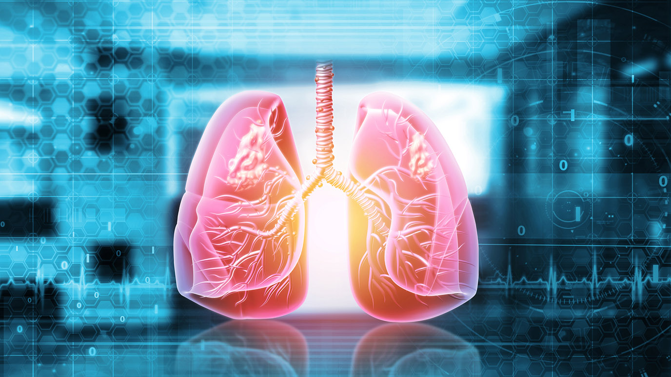 Poziotinib is active in EGFR exon 20 mutant non-small cell lung cancer ...