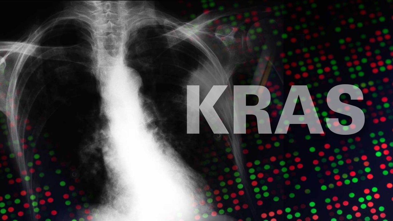 Newly FDA-approved targeted therapy sotorasib prolongs survival in KRAS ...