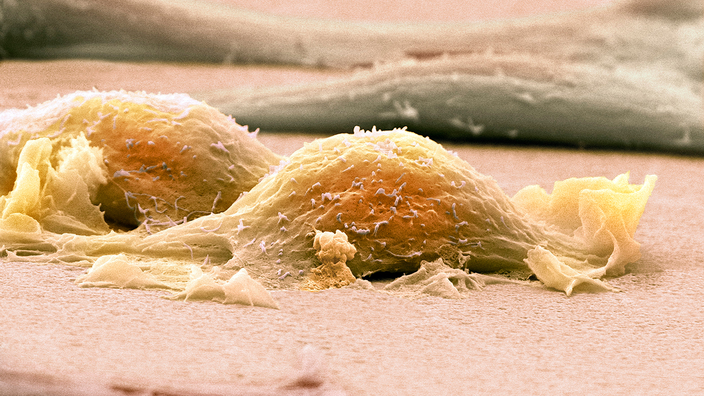 Immunotherapy before surgery leads to promising long-term survival in ...