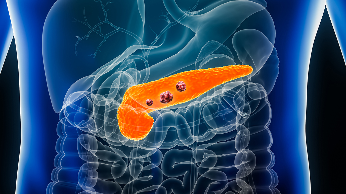New-onset diabetes may serve as an early marker of pancreatic cancer ...