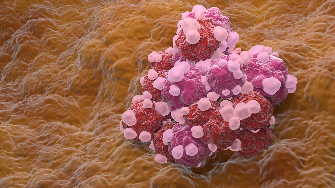 Study provides insights into advanced ovarian cancer tumors after ...