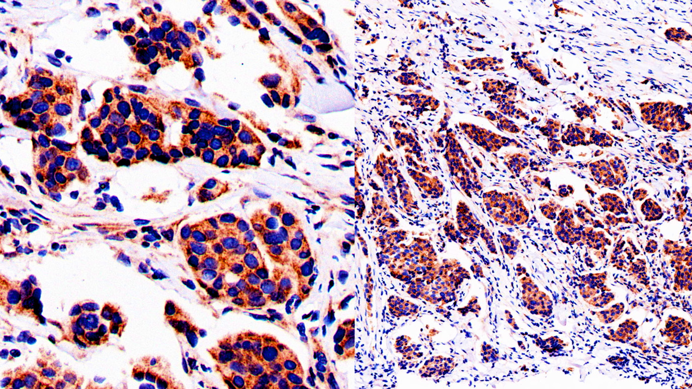 Study identifies a new driver and therapeutic vulnerability of bone ...