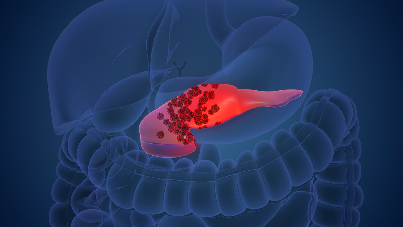 Comprehensive spatial map provides insights into pancreatic cancer ...