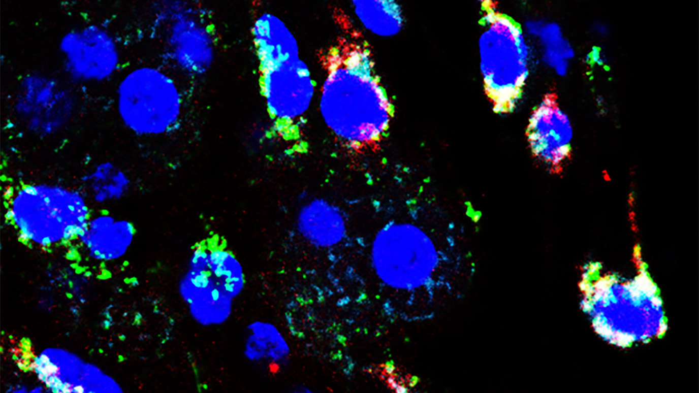 Fluorescent tracer helps identify precancerous lesions in pancreatic ...