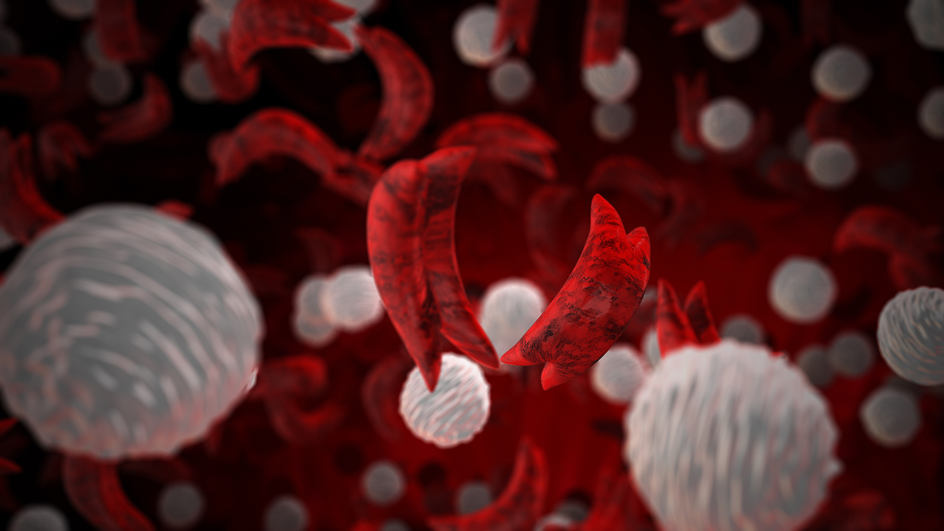 Sickle cell disease changes DNA structure of cells to suppress immunity ...
