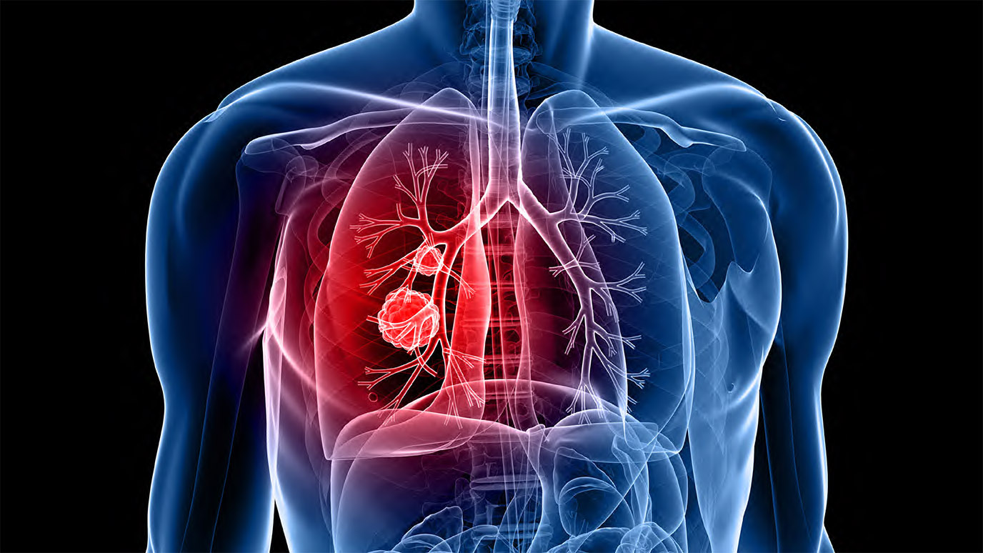 Lung cancer study finds new target for treatment resistance after EGFR ...