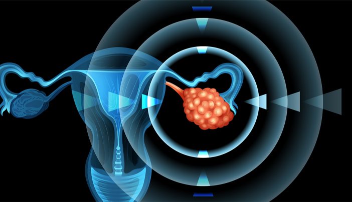 Ovarian Cancer Analysis Identifies Potential Treatment Biomarkers Md